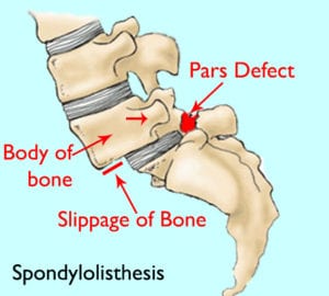 Spondylolistehsis: where one bone, slips on the other- know everything