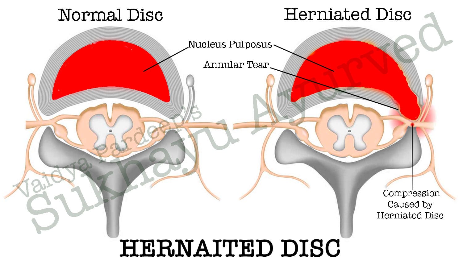 T8 T9 Spinal Disc